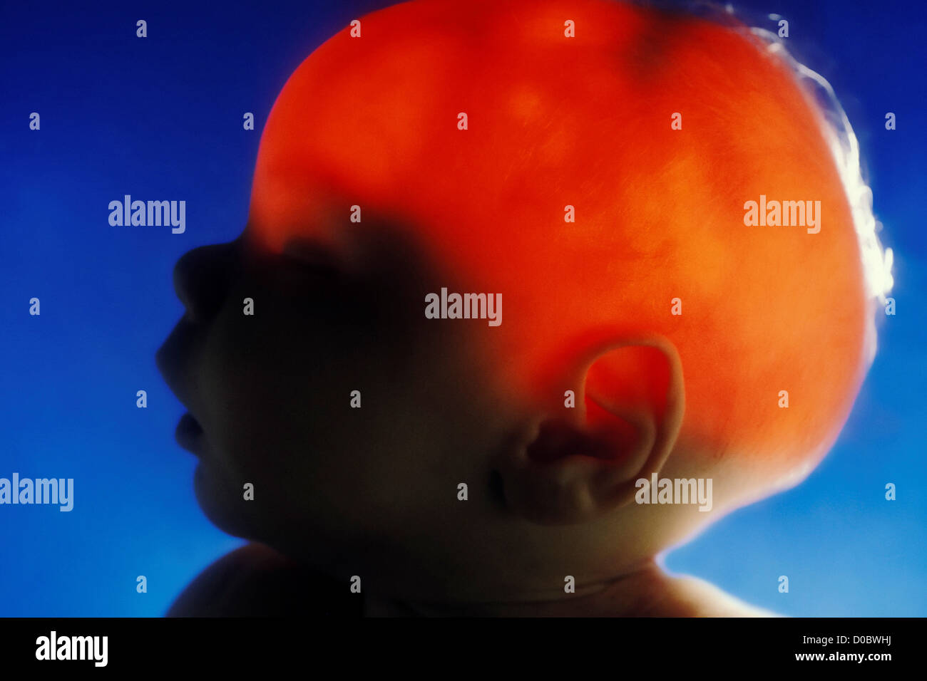 Babies With Hydranencephaly