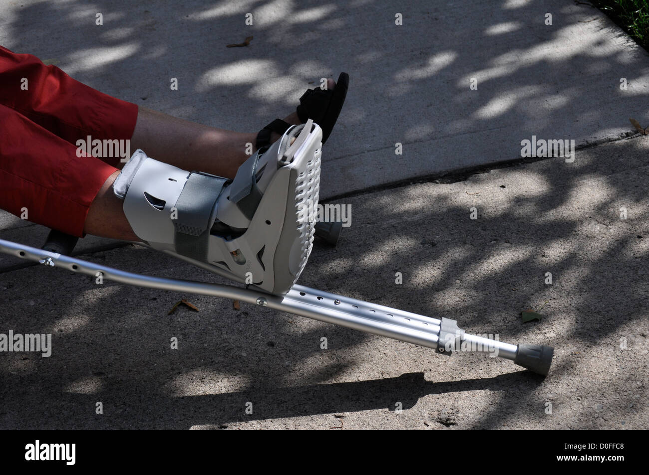 Open fracture leg hi-res stock photography and images - Alamy