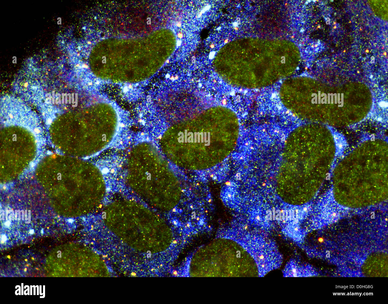 Cancer Cells Deprived of Glucose Get Stressed, Microscopic View Stock ...