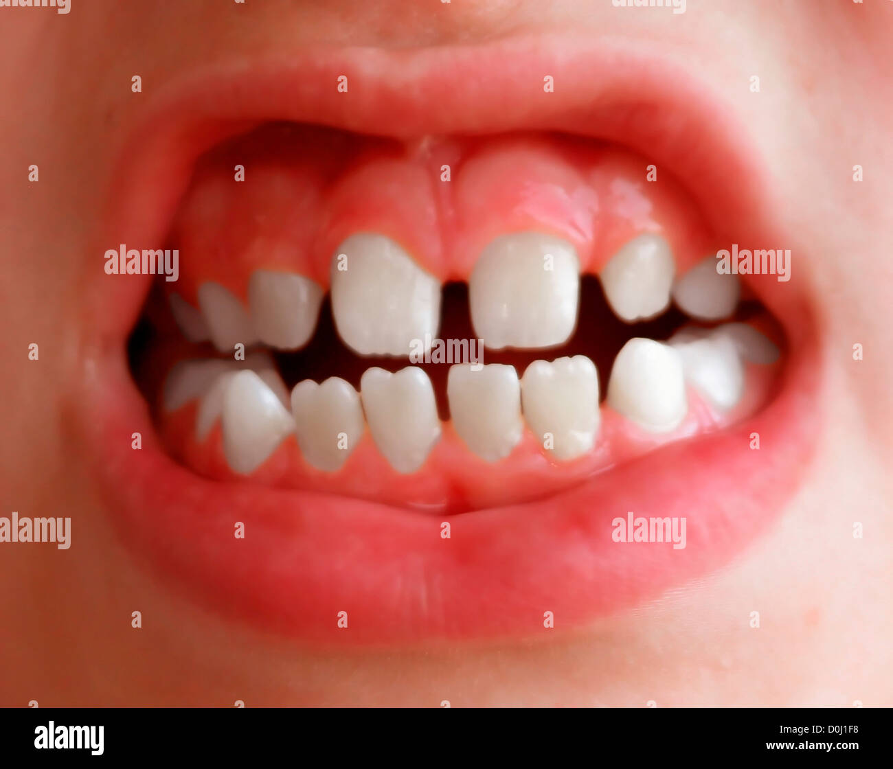 A Child's Grimacing Mouth and Teeth Stock Photo - Alamy