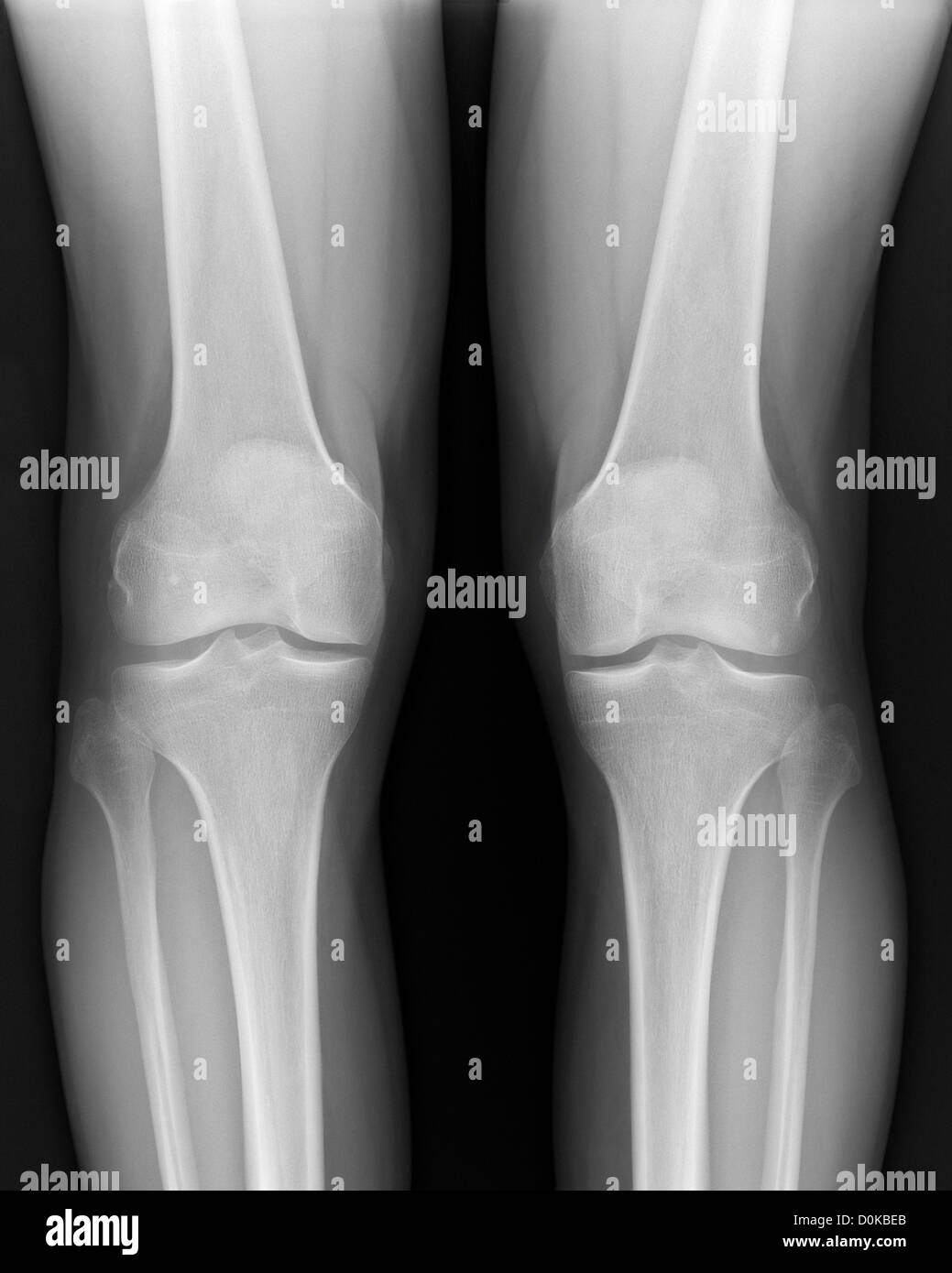 Fibula: Definition, Location, Anatomy, Functions, Diagrams, 49% OFF Fibula: Definition, Location, Anatomy, Functions, Diagrams, 49% OFF