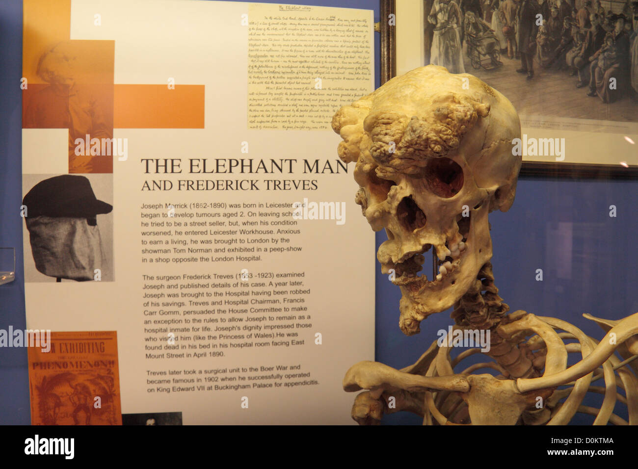 The elephant man High Resolution Stock Photography and Images - Alamy