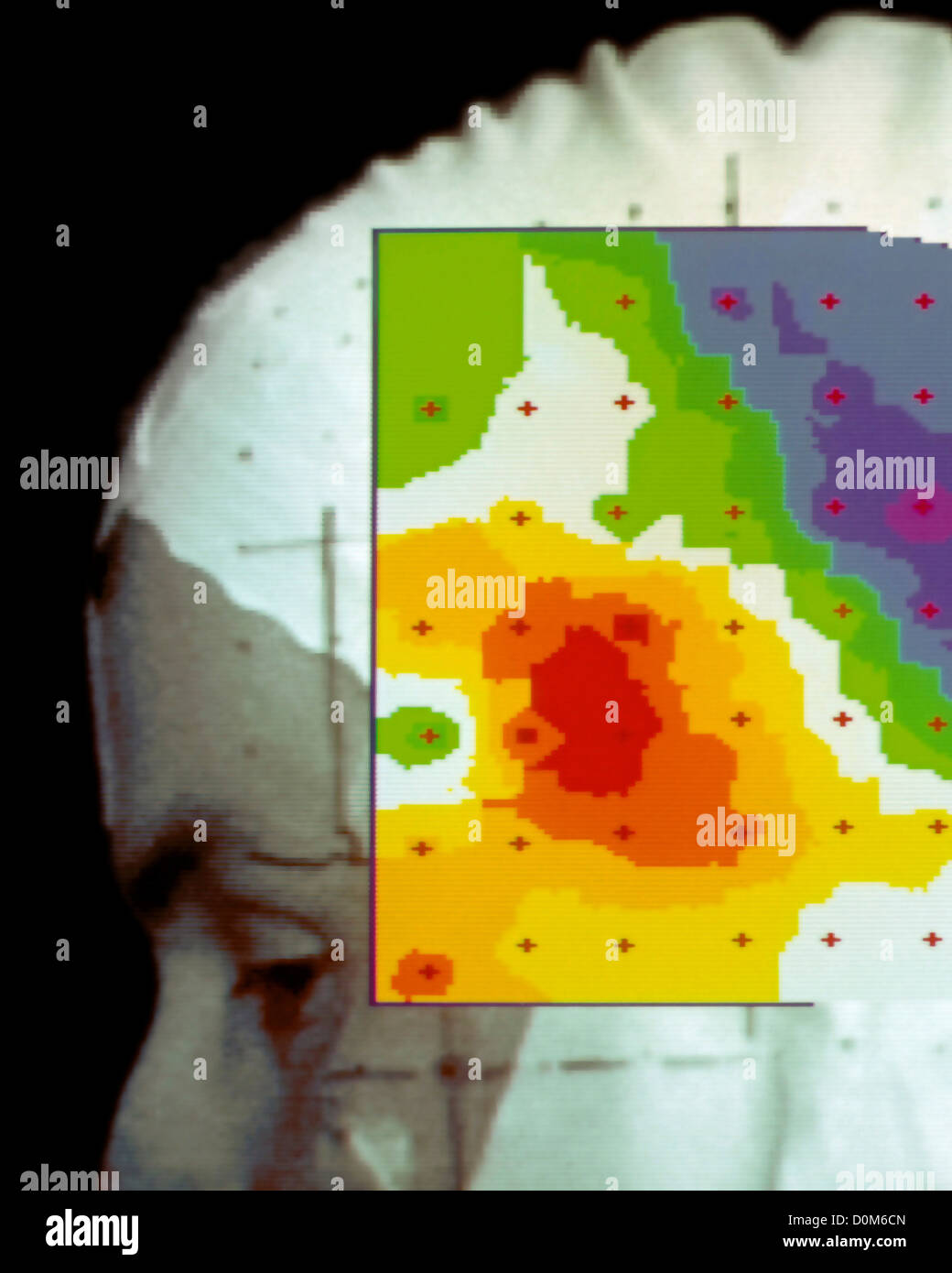Brain Scan in Neurological Study Stock Photo - Alamy