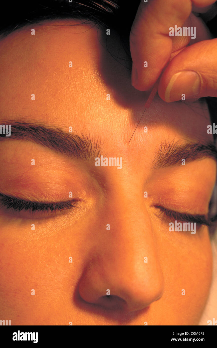 Acupuncturist Inserting Needle into Patient's Forehead Stock Photo - Alamy