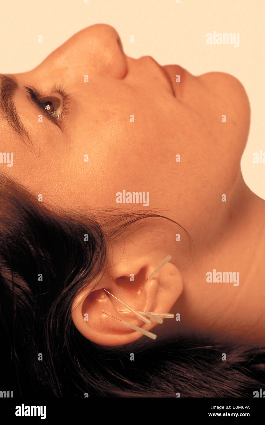 Profile of Patient with Acupuncture Needles in Ear Stock Photo - Alamy