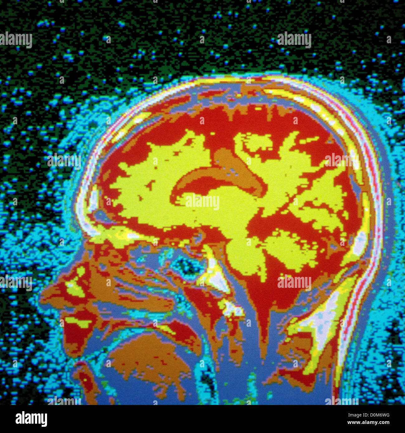 Computer Screen with Image of Brain Scan Stock Photo - Alamy
