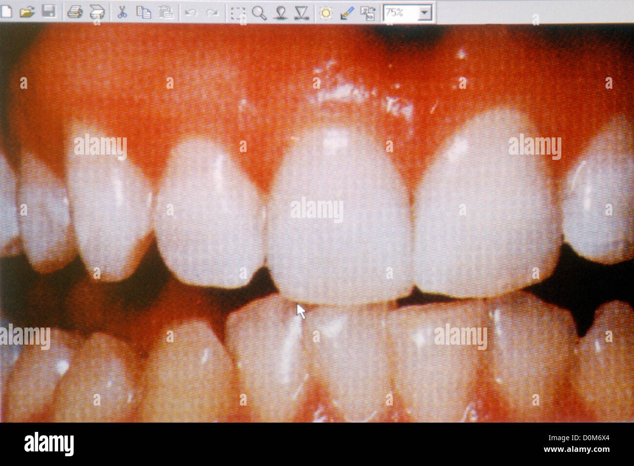 Computer Screen Displays Dental Patient's Gums and Teeth Stock Photo ...