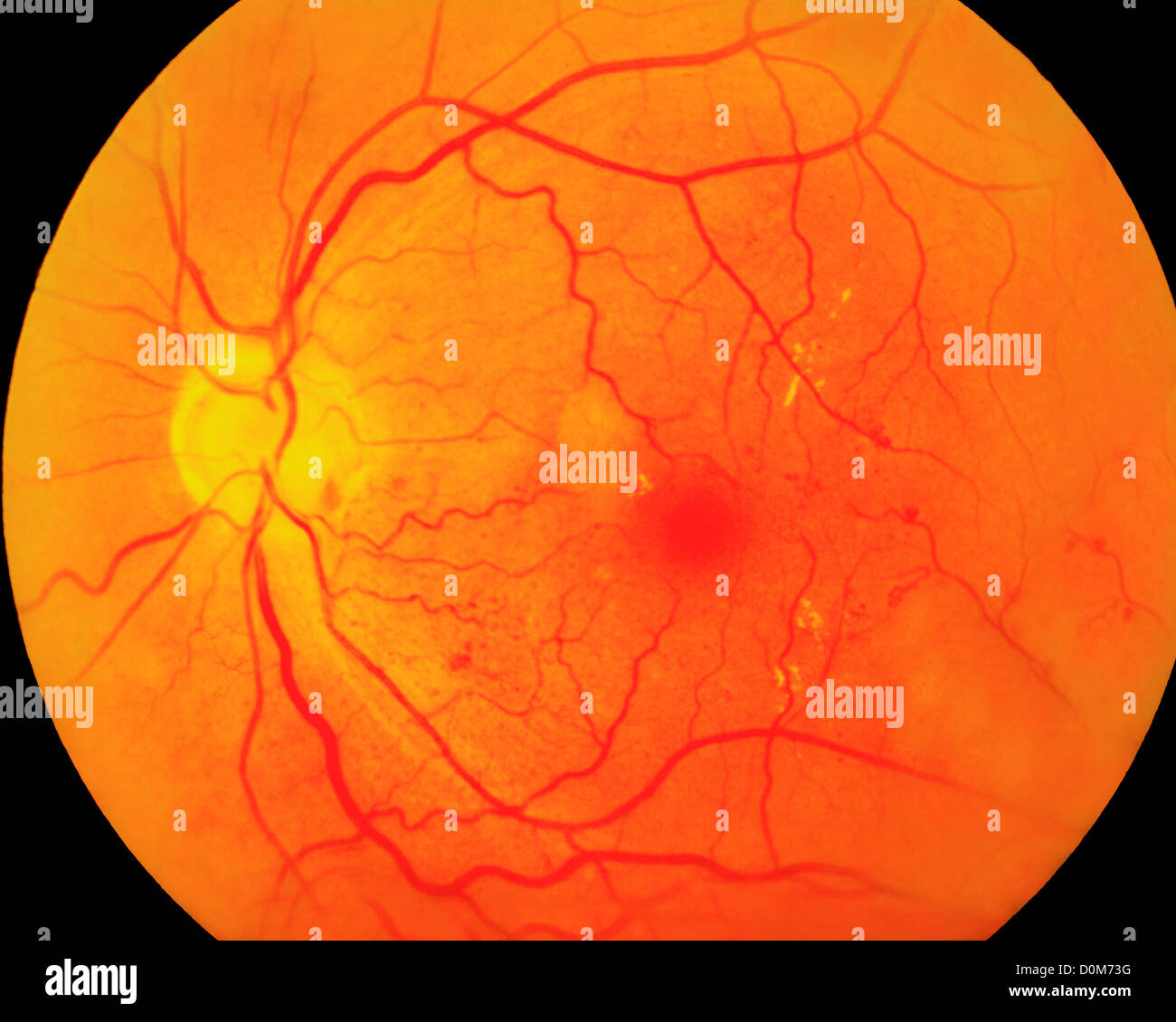 Microaneurysm High Resolution Stock Photography and Images - Alamy