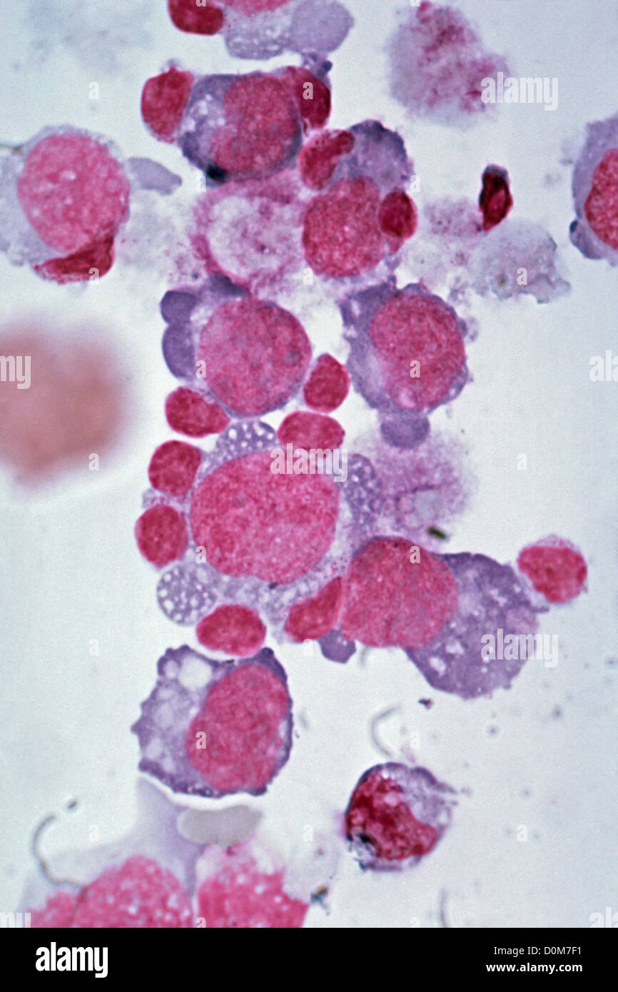 Cancer micrograph hi-res stock photography and images - Alamy