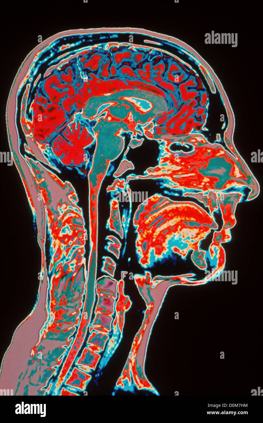 Mri of neck hi-res stock photography and images - Alamy