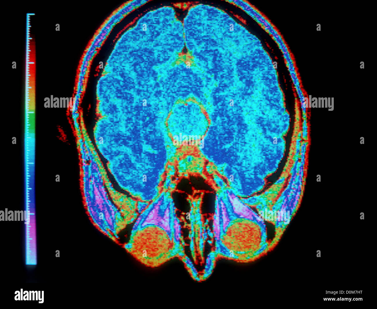 MRI View of the Human Brain Stock Photo - Alamy