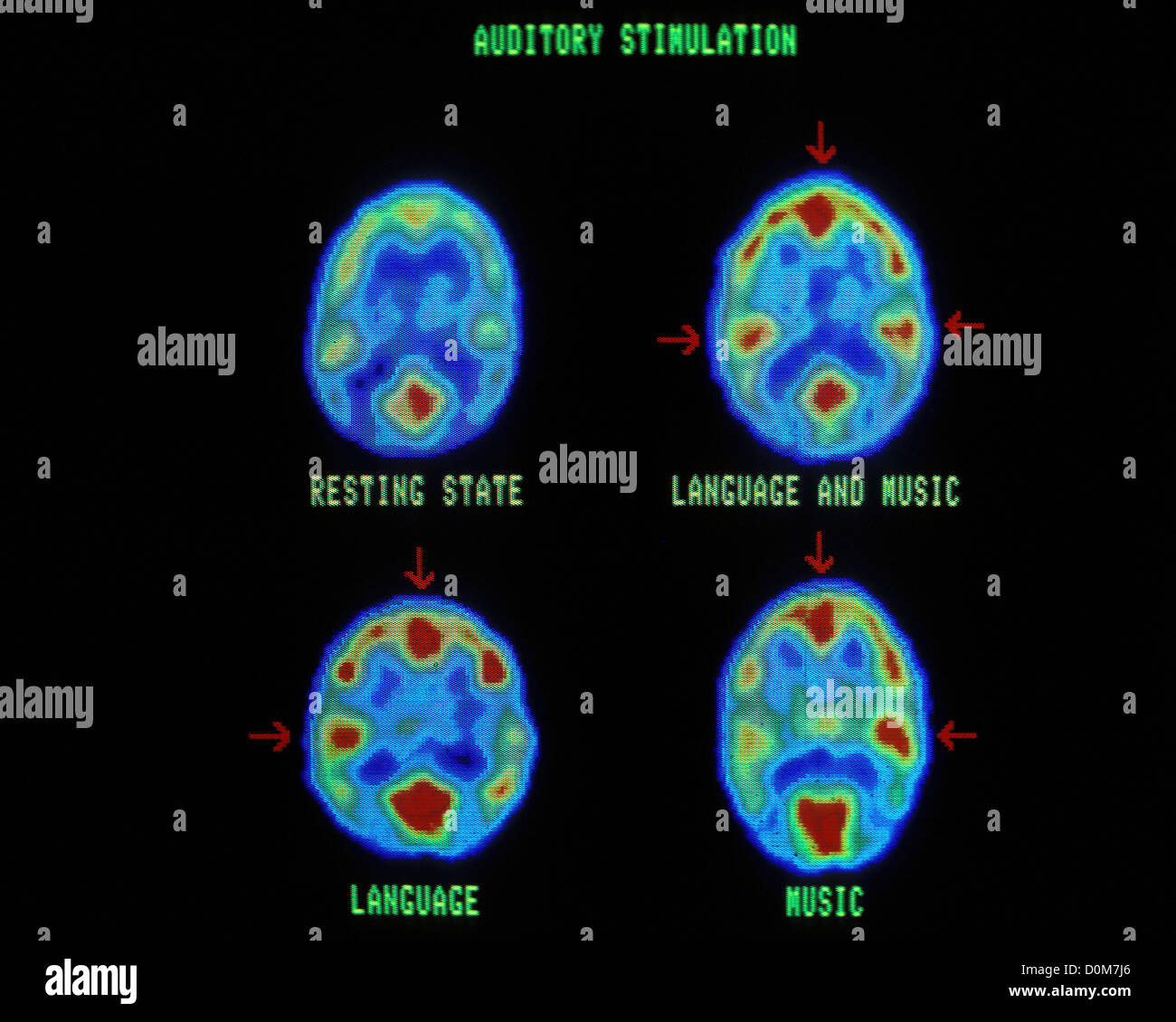 PET Scans Show Brain's Response to Auditory Stimulation Stock Photo - Alamy PET Scans Show Brain's Response to Auditory Stimulation Stock Photo - Alamy