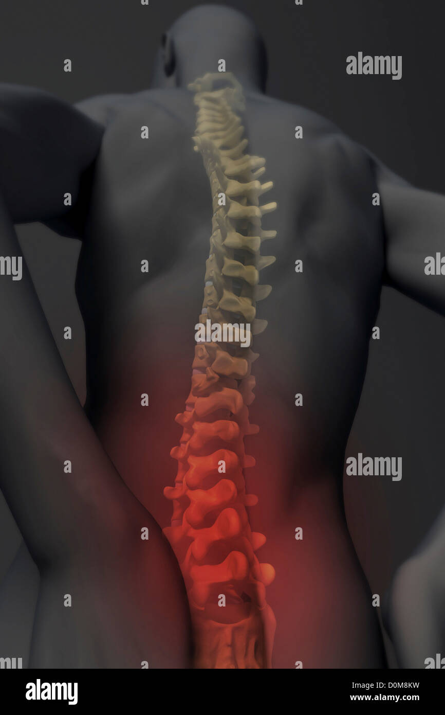 Rear view of a male figure with back pain. The spine is visible and is ...