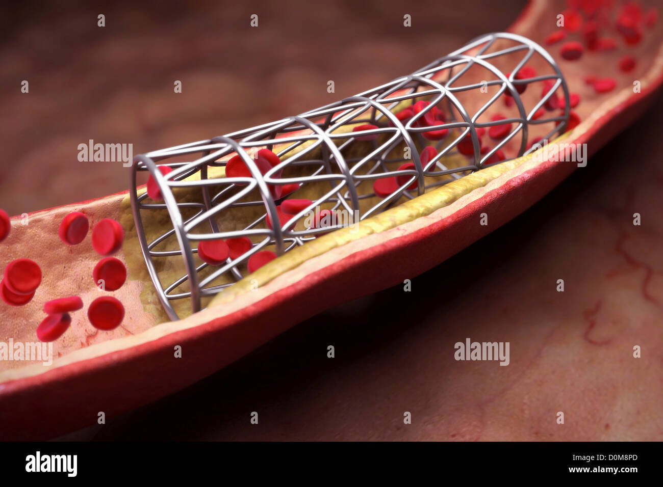 Close-up view of a coronary stent or angioplasty Stock Photo - Alamy