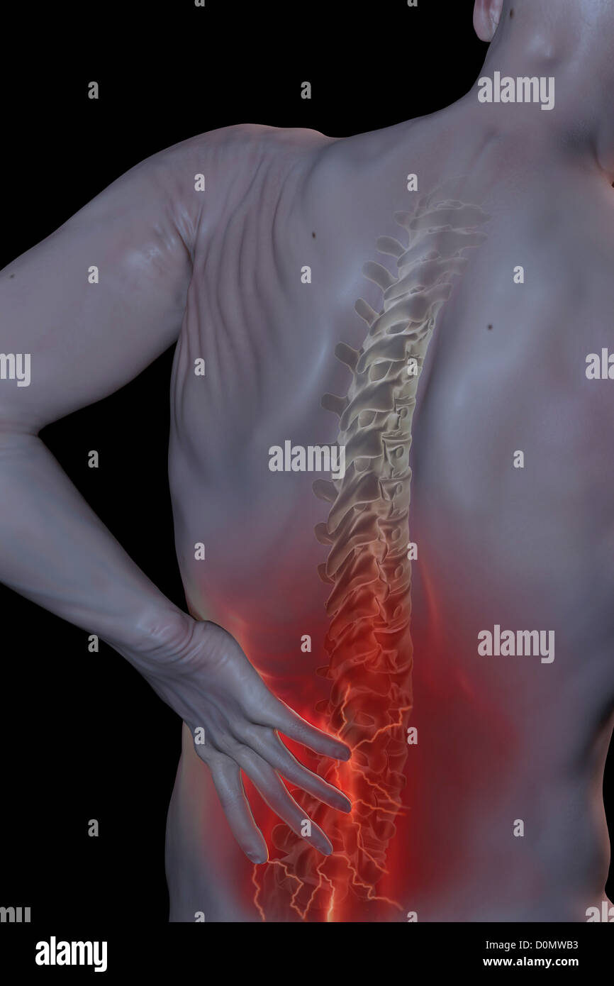 Anatomical model showing an inflamed area affected by back pain Stock ...