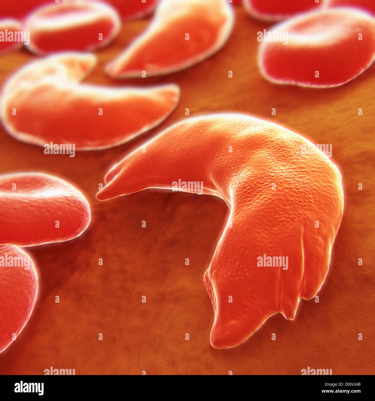 Sickle-cell disease sickle-cell anaemia or drepanocytosis is recessive ...