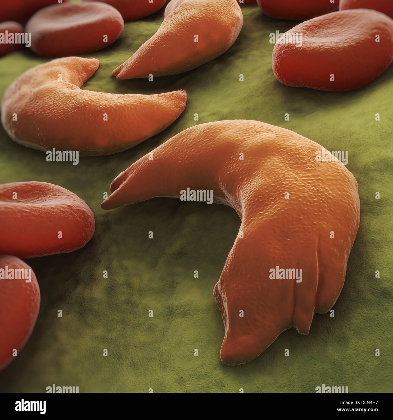 Sickle-cell disease sickle-cell anaemia or drepanocytosis is recessive ...