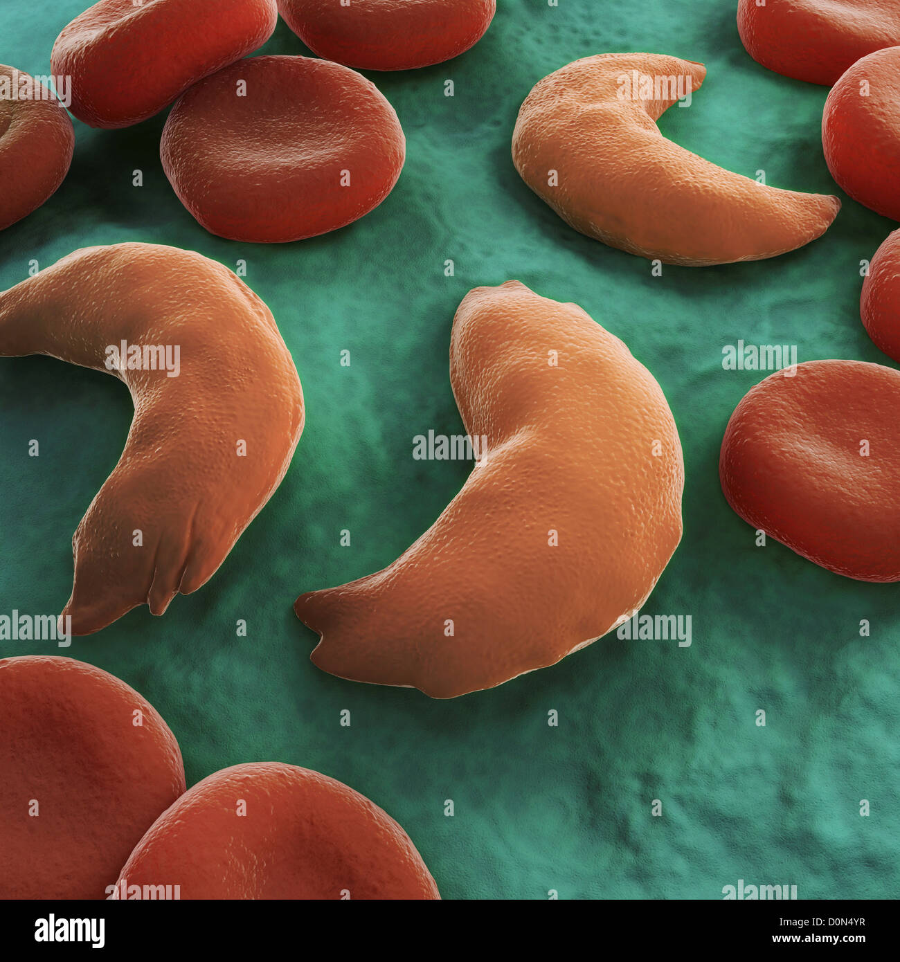 Sickle-cell disease sickle-cell anaemia or drepanocytosis is recessive ...