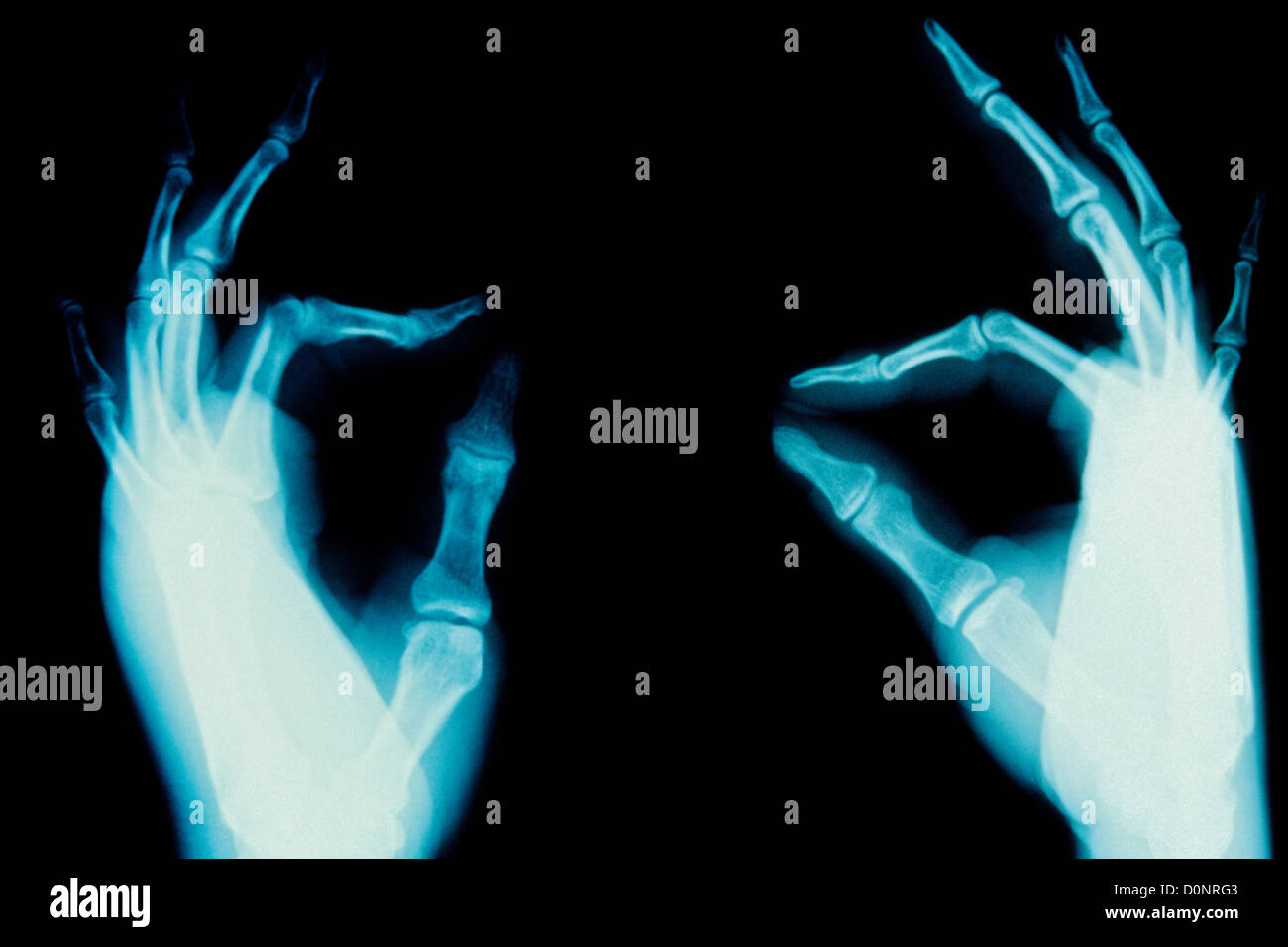 X-ray of Two Human Hands Stock Photo - Alamy