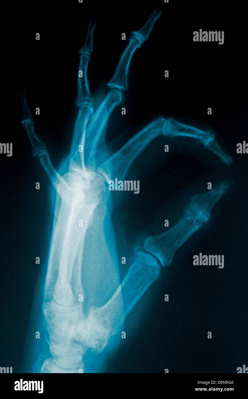 X-ray of a Human Hand with Thumb and Pointer Finger Touching Stock ...