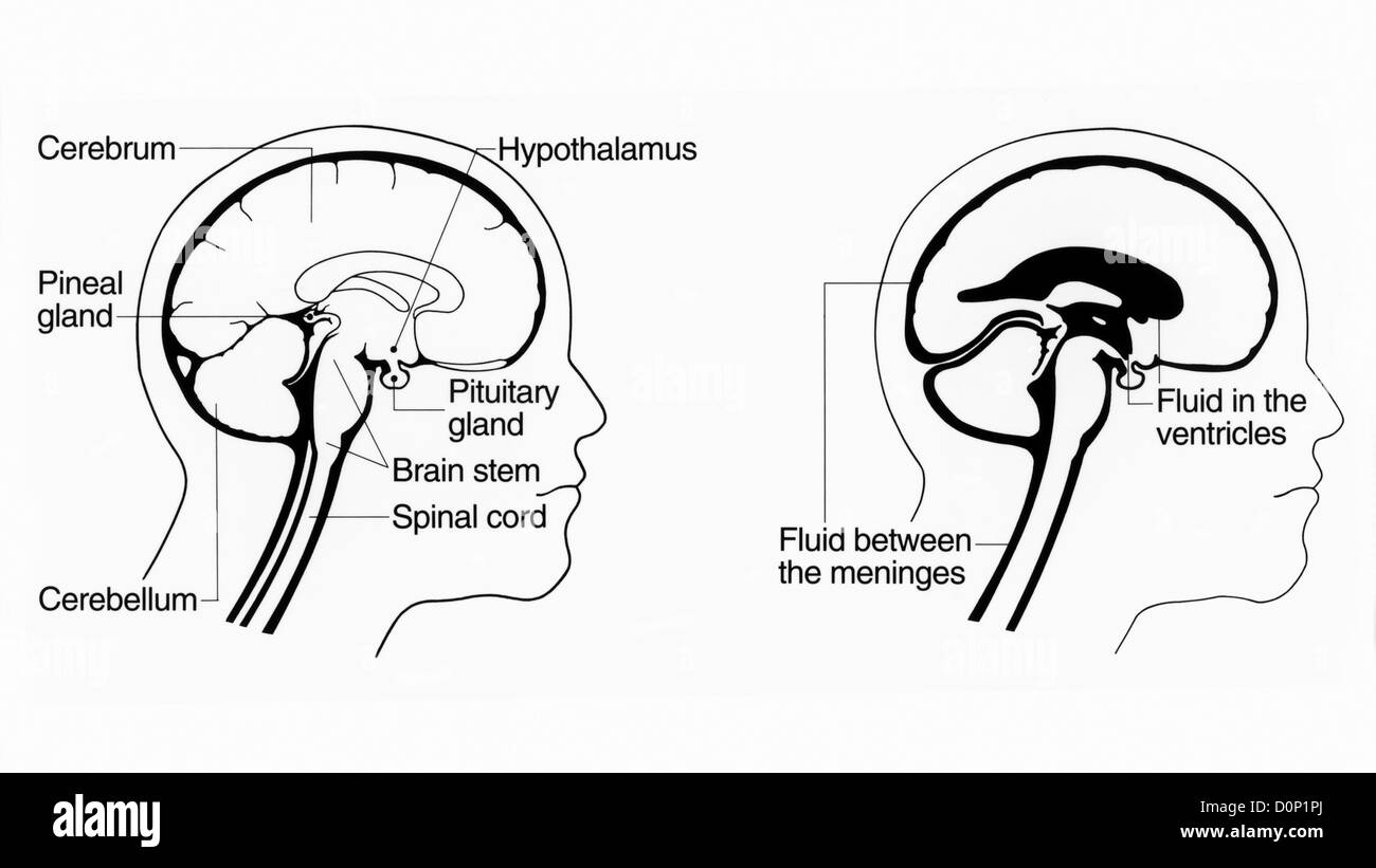 A cutaway illustration showing buildup cerebral fluid caused brain ...