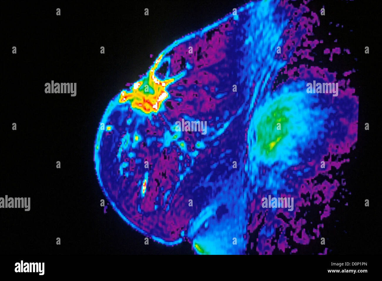 This color-enhanced slide shows a magnetic resonance image (MRI) of an ...