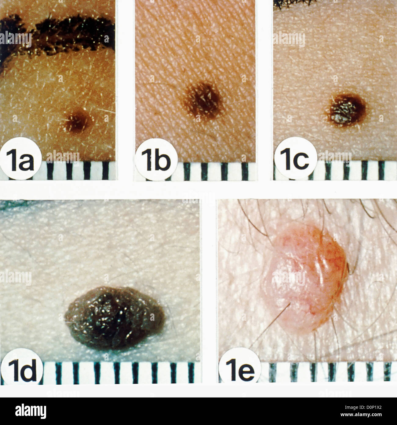 Natural history common acquired nevi. Ordinary moles begin as uniformly ...