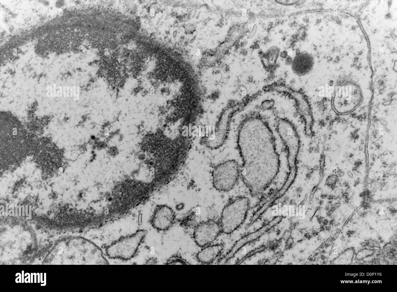 An electron microscope's view of a fibrosarcoma, a malignant tumor ...