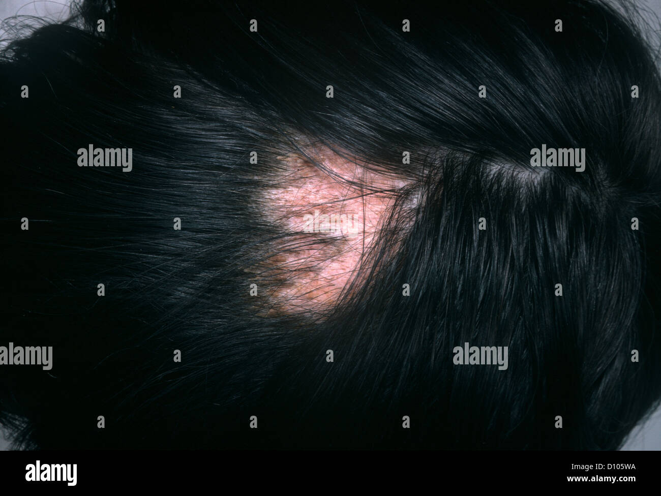 Tinea capitis scalp hi-res stock photography and images - Alamy