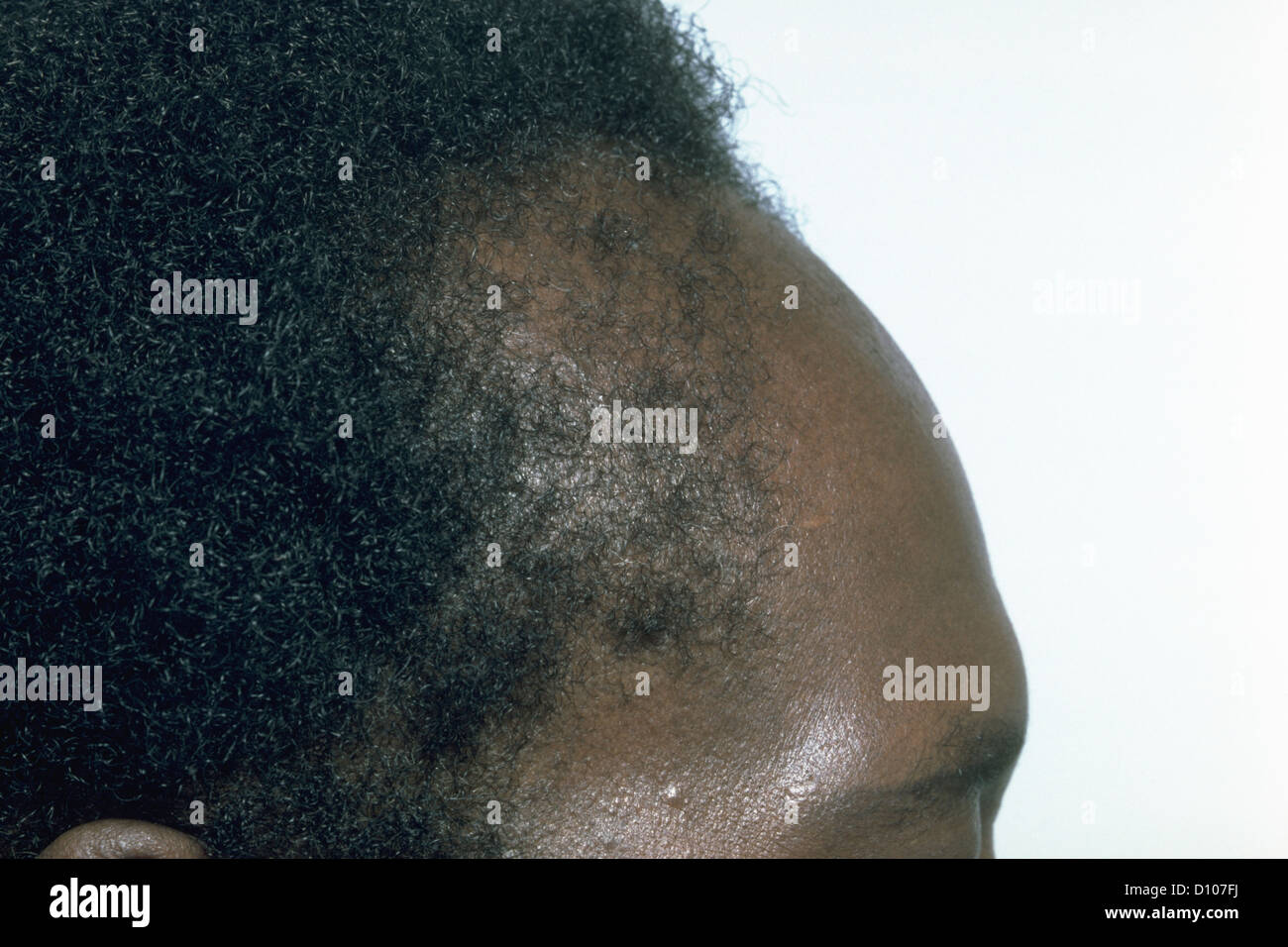 Traumatic alopecia hi-res stock photography and images - Alamy