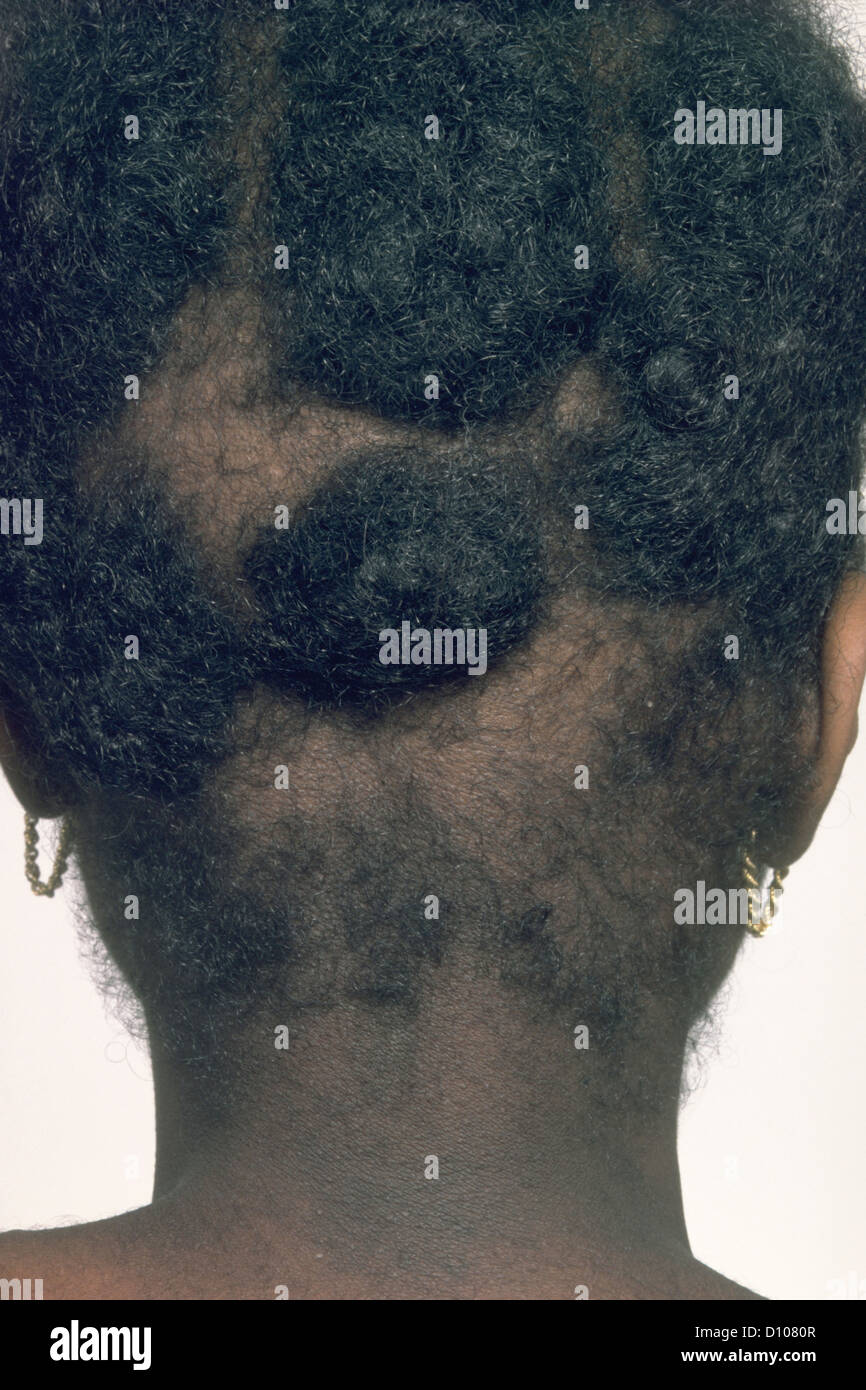 Traumatic alopecia hi-res stock photography and images - Alamy