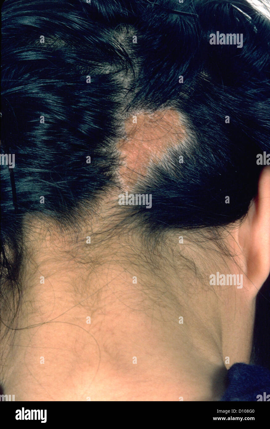 Epidermal nevus hi-res stock photography and images - Alamy