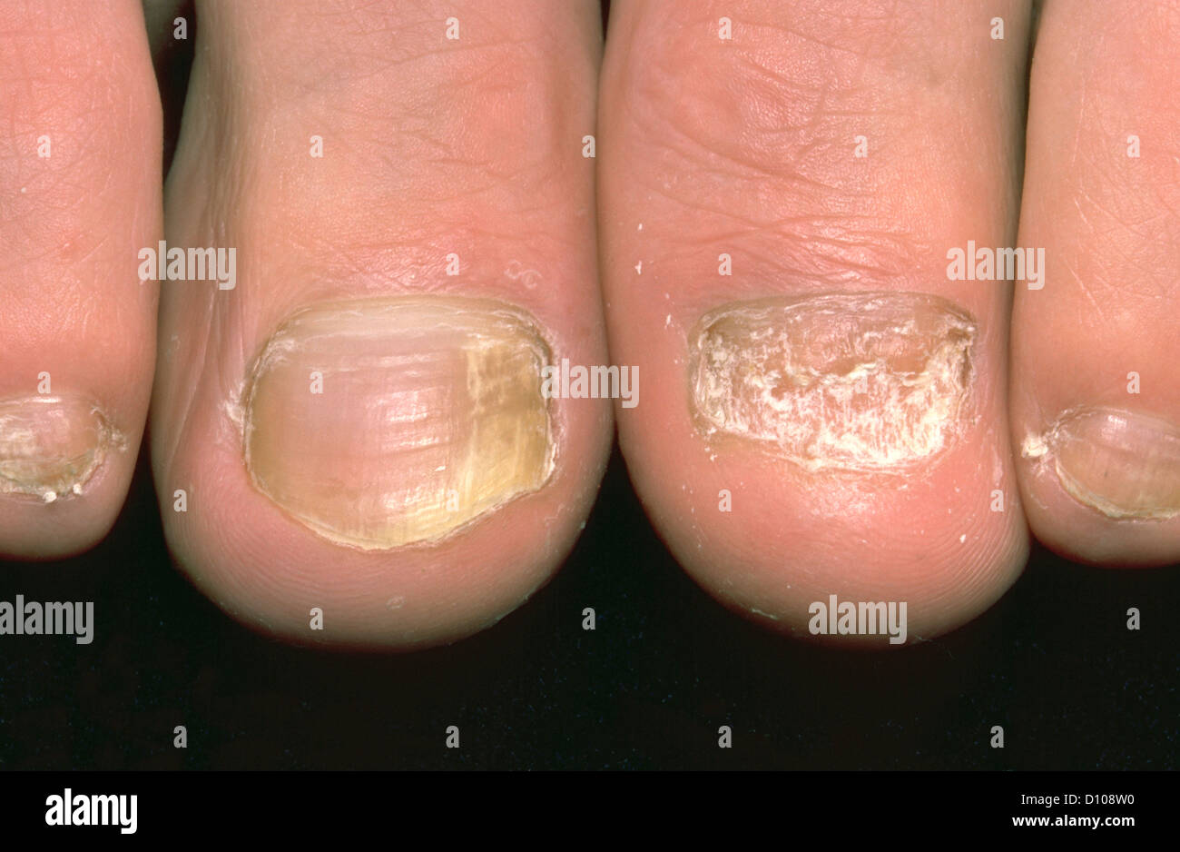 Dermatophytosis High Resolution Stock Photography and Images - Alamy