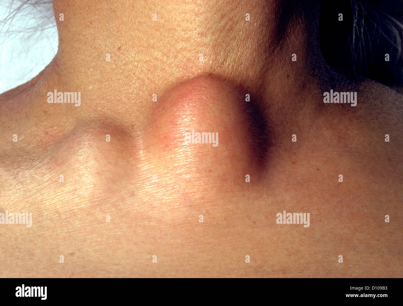 Lump neck hi-res stock photography and images - Alamy