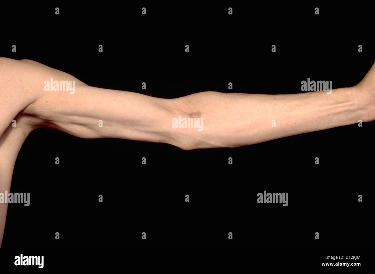 Lipodystrophy syndrome hi-res stock photography and images - Alamy