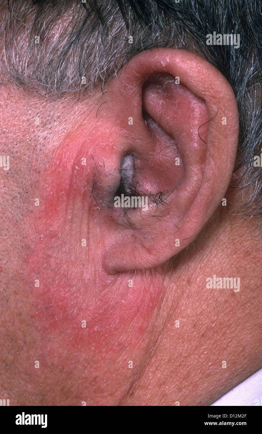 Otitis externa hi-res stock photography and images - Alamy