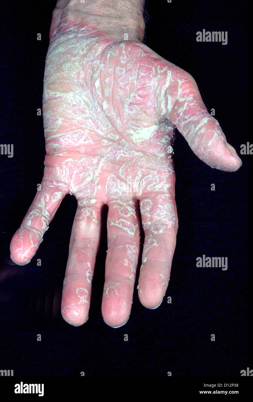 Bleeding Dry High Resolution Stock Photography and Images - Alamy