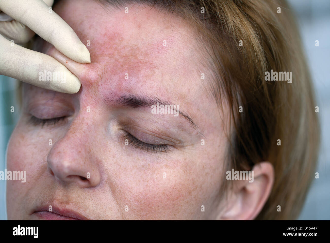 Supraorbital hi-res stock photography and images - Alamy