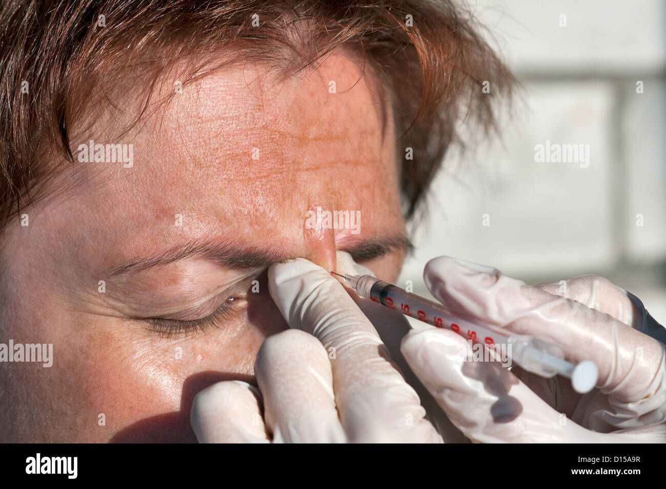 Botox injection into bridge of the nose, close up Stock Photo - Alamy
