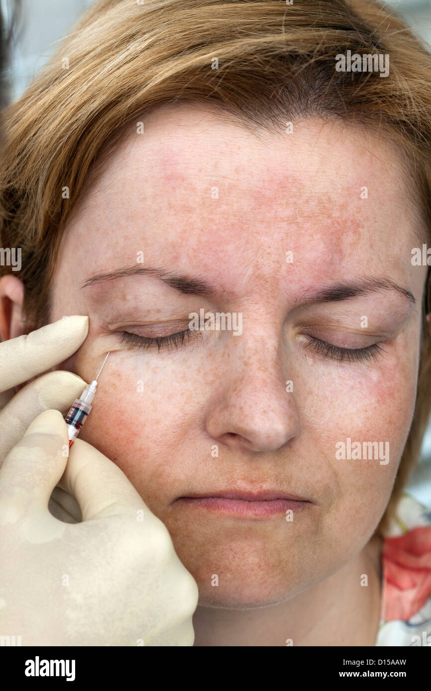 Botox injection in the eye corner, close up Stock Photo - Alamy