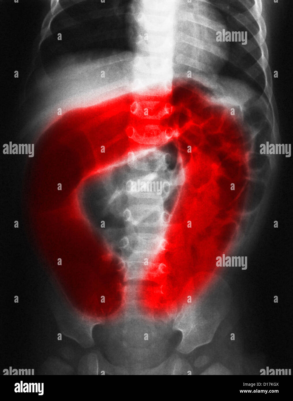Body x-ray of 11 month child with bowel obstruction Stock Photo - Alamy