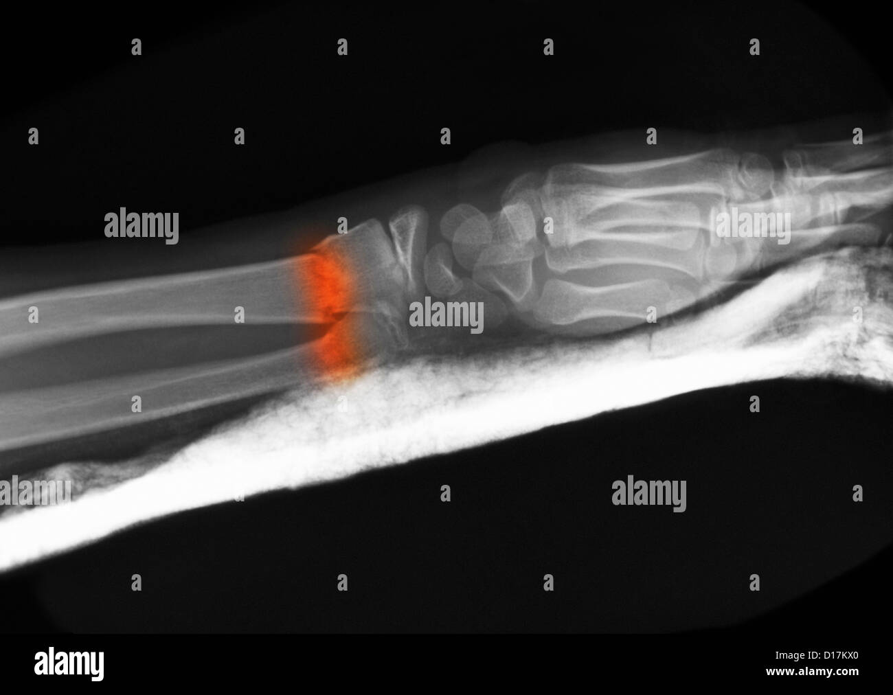 X-ray of a distal forearm fracture Stock Photo - Alamy