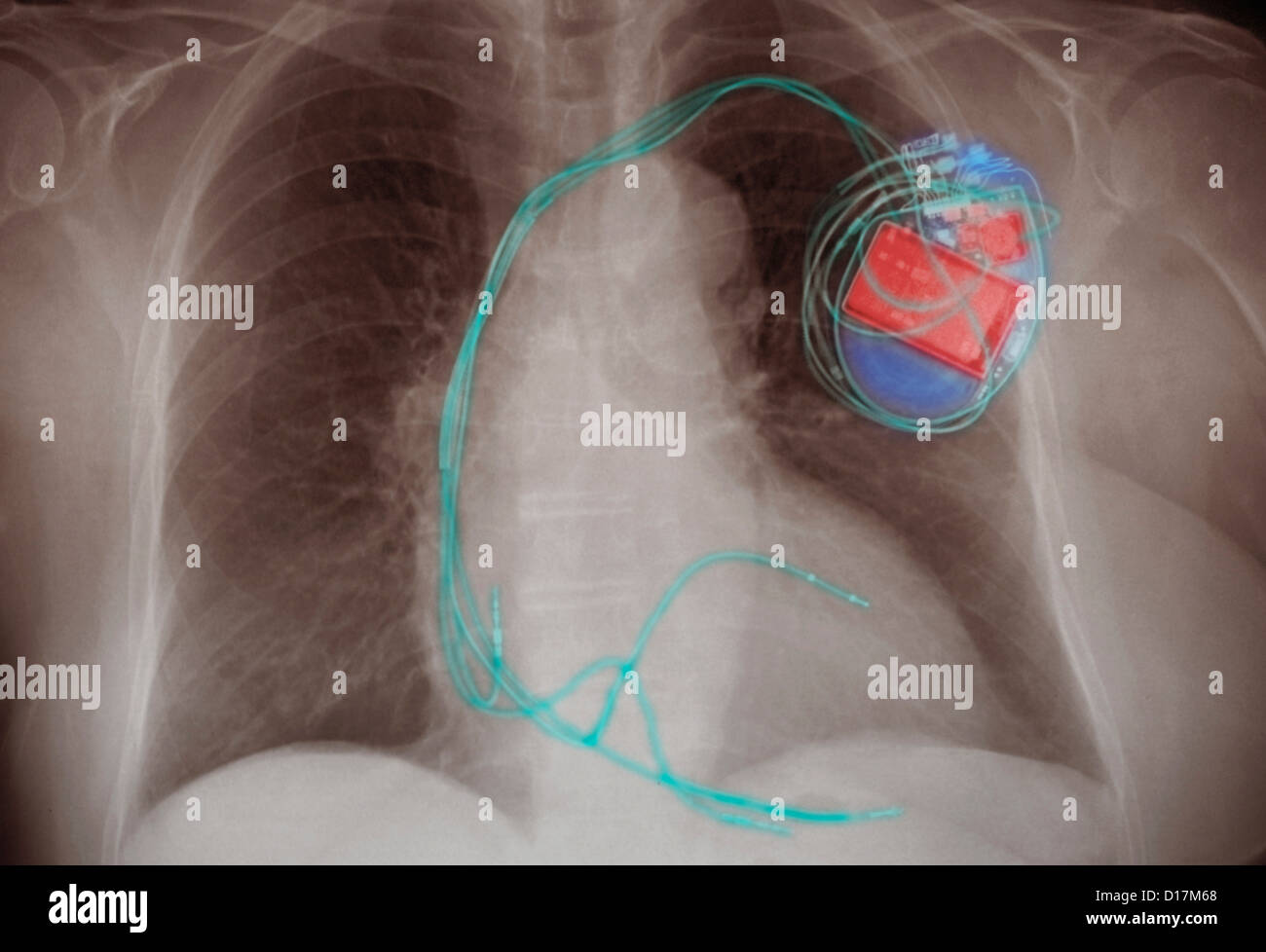 Implant pacemaker hi-res stock photography and images - Alamy