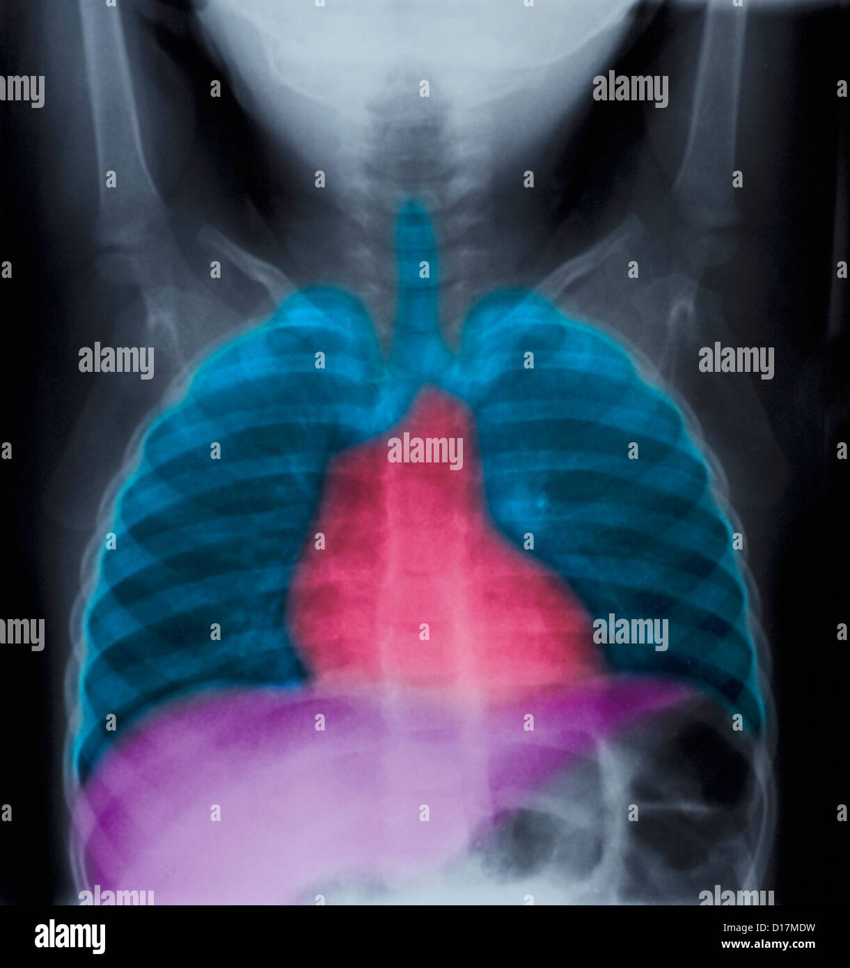 Normal Child Chest X Ray