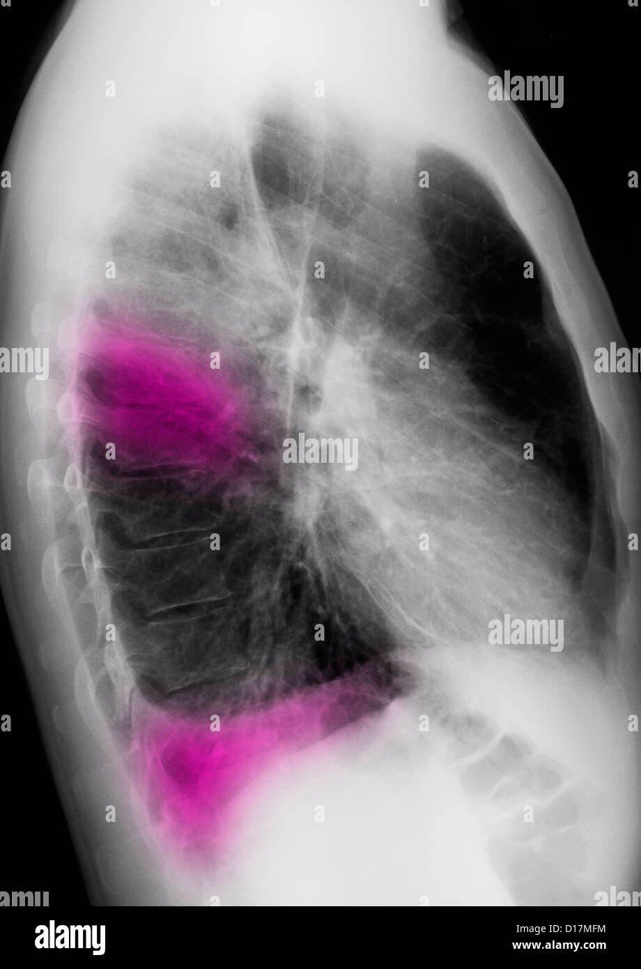 Chest X-ray of man with infiltrate in right lung Stock Photo - Alamy