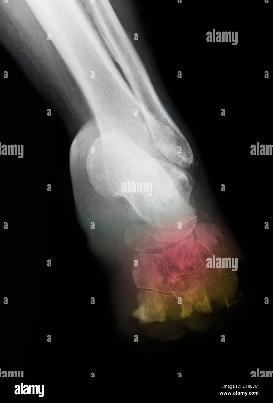 X ray image image of female foot hi-res stock photography and images ...