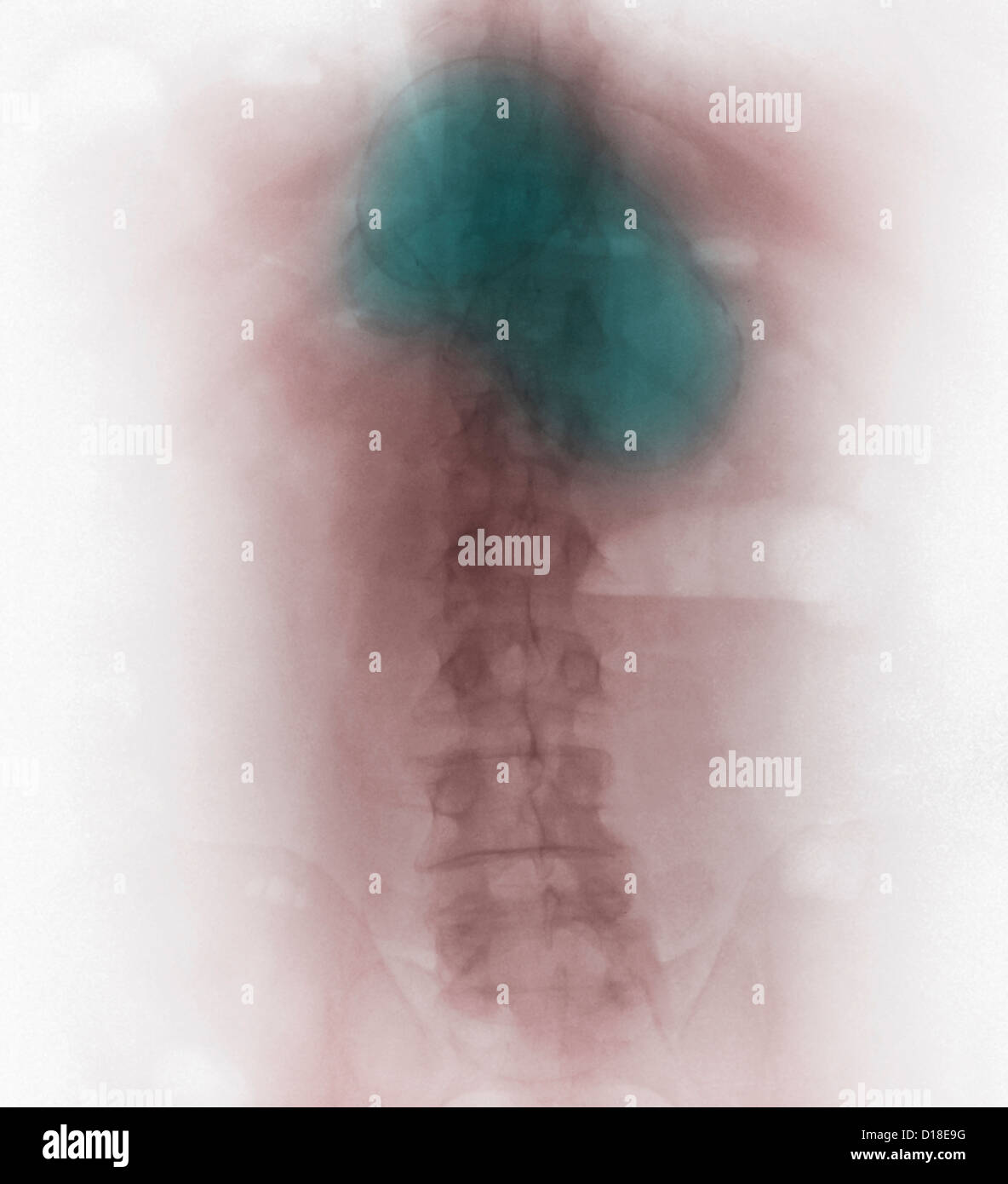 Pancreas x ray hi-res stock photography and images - Alamy