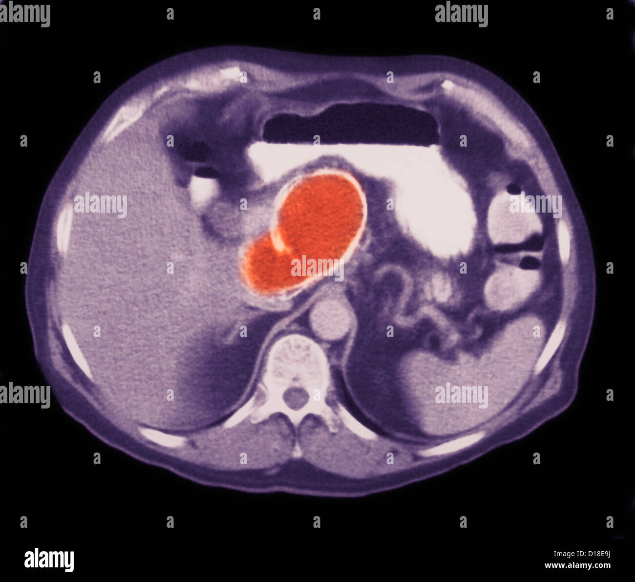 Pancreatic pseudocyst seen on MRI Stock Photo - Alamy