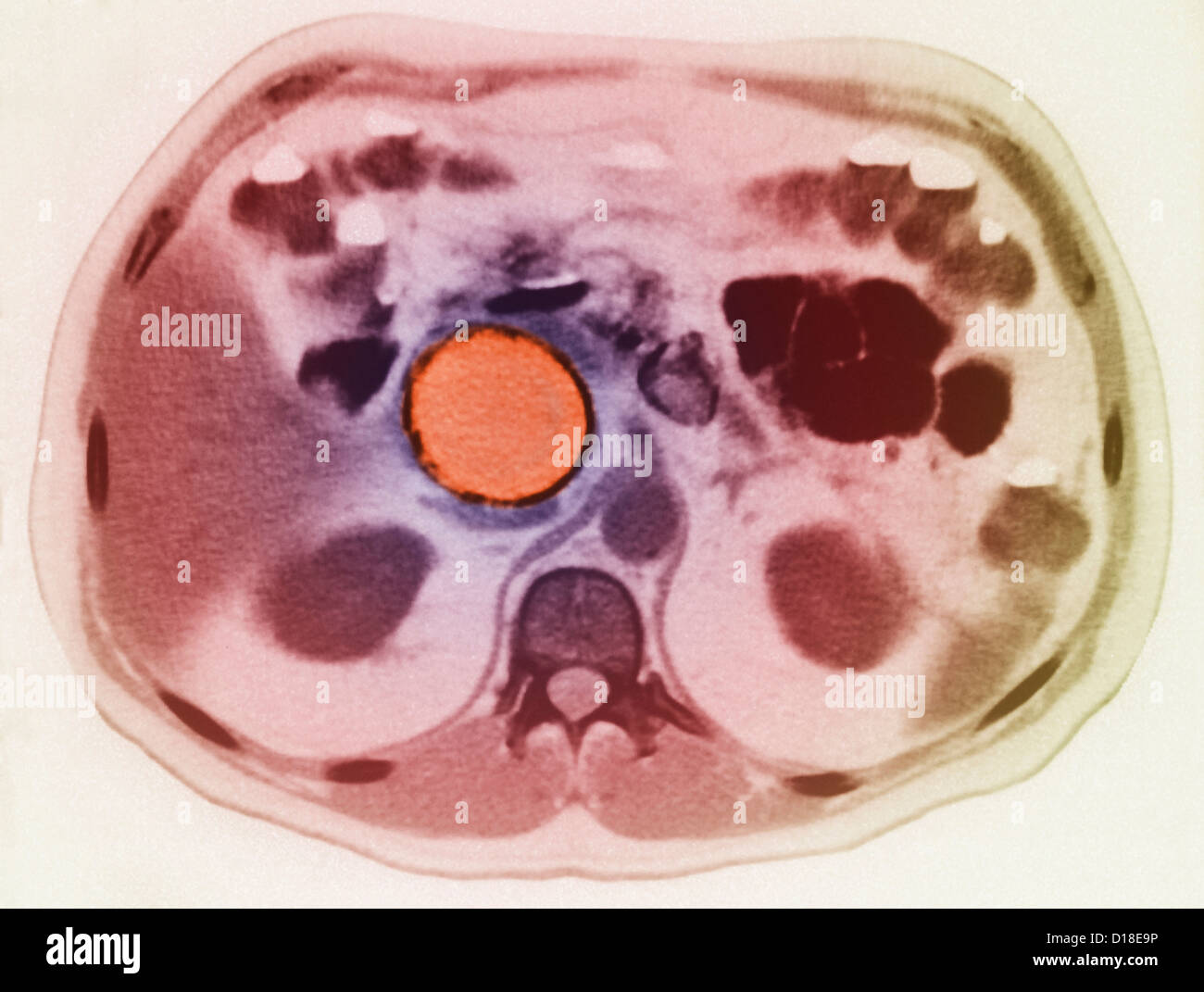 Pancreatic pseudocyst seen on MRI Stock Photo - Alamy