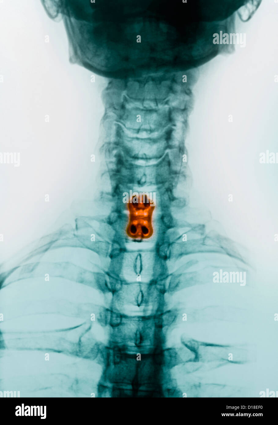 Cervical spine xray, spinal fusion, screws, plate Stock Photo - Alamy